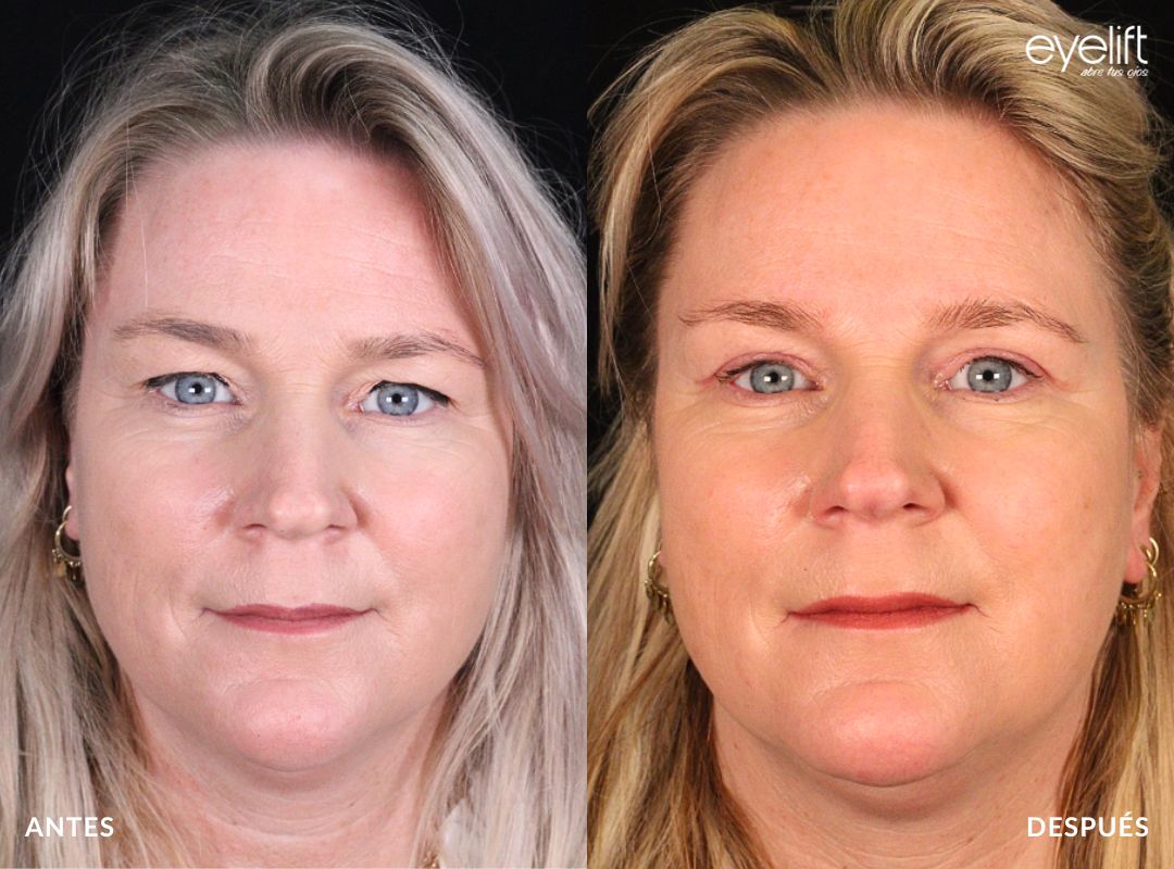 Blefaroplastia: Cirugía de Párpados en Madrid | Eyelift